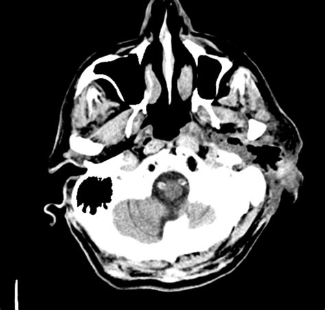 Emergency Medicine Educationmalignant Otitis Externa