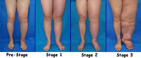 Lymphedema Causes Stages Lymphatic System And Treatment