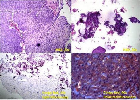 Sheet Of Polyhedral Epithelial Cells Interspersed By Calcifications And Download Scientific