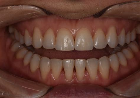 Case 3 Traditional Braces Private And Cosmetic Dentist In Warrington Dental Solutions