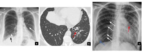 Allergic Bronchopulmonary Aspergillosis Mycosis An Underdiagnosed