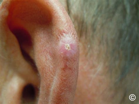 Chondrodermatitis Nodularis Helicis