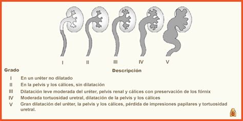 Reflujo Vesicoureteral Rvu En Bebés Y Niños Pequeños