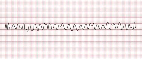 Ventricular Fibrillation Causes Symptoms And Treatment