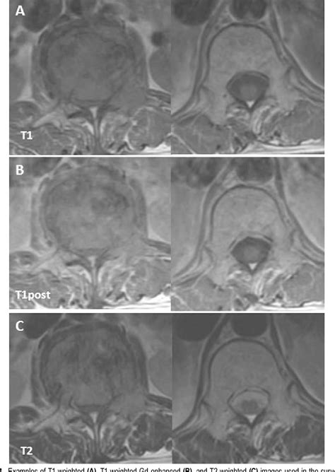 Epidural Spinal Cord Compression Scale At Todd Reno Blog