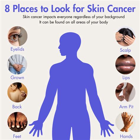How To Perform A Self Skin Exam Dermondemand