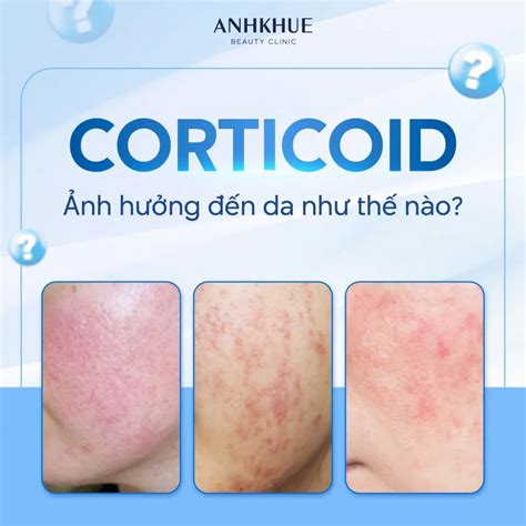 Những Sự Thật đáng Sợ Về Mỹ Phẩm Chứa Corticoid Không Rõ Nguồn Gốc