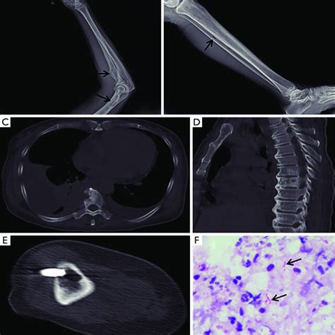 A 58 Year Old Woman With Multiple Osteolytic Lesions A B X Rays Of Download Scientific