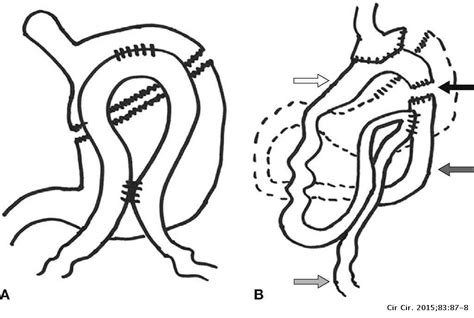 The Origin Of The Simplified Gastric Bypass Cirugía Y Cirujanos