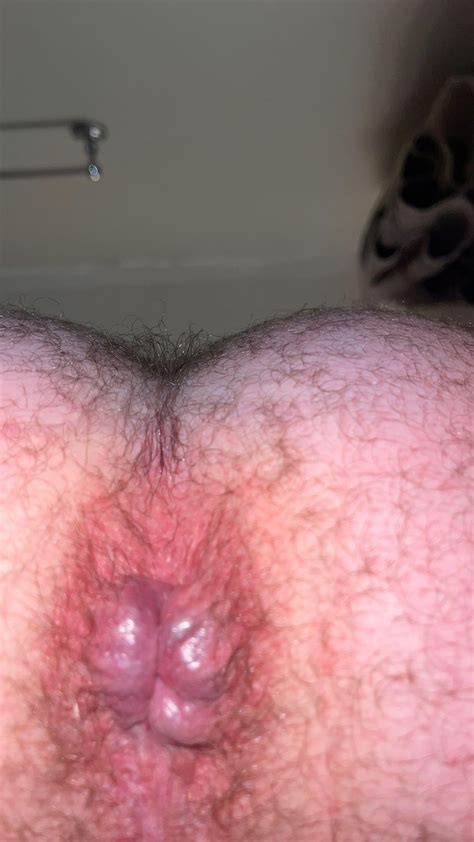 Does This Look Like Hemorrhoids Rhemorrhoid