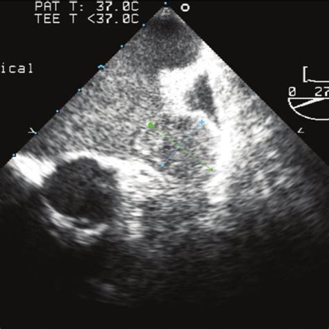 Transoesophageal Echo Showed Large Left Atrial Appendage Clot