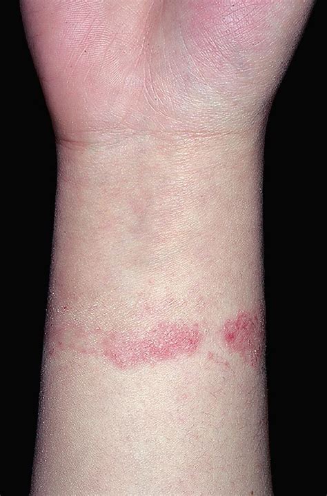 Contact Dermatitis And Patch Testing Clinical Tree