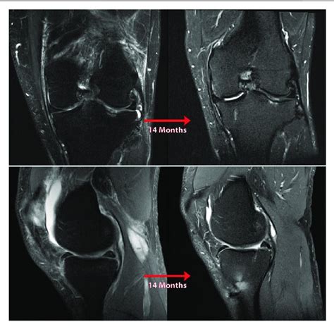 The Hughston Classification Classification Of Posterolateral Download Scientific Diagram