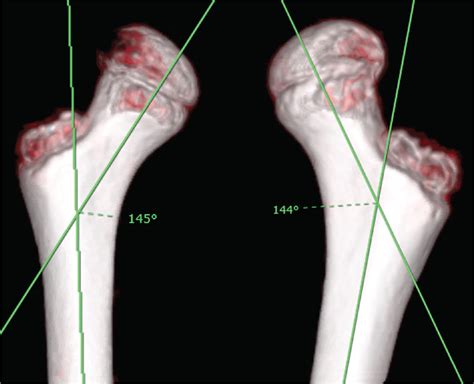 Use Of 3d Imaging In Planning Varus Derotation Osteotomy In