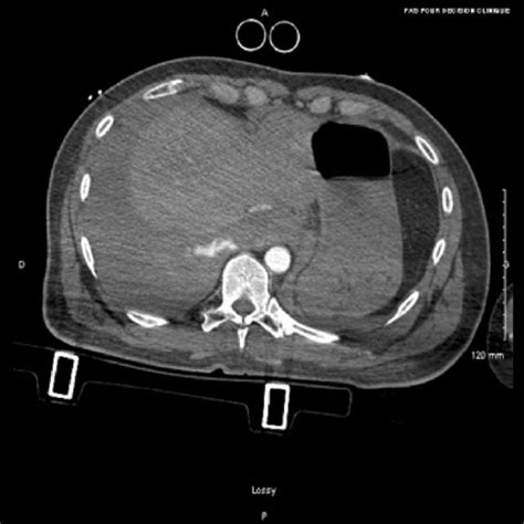 Thoracic Packing To Treat Severe Bleeding In Thoracic Compartment Download Scientific Diagram
