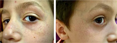 Petechiae Eyelid