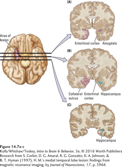 Mesial Temporal Lobe Anatomy