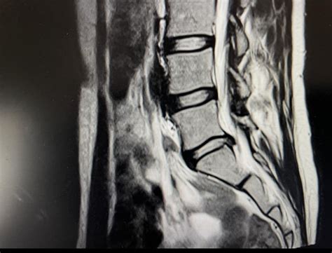 Its Probably Not Your Disc” Rsciatica