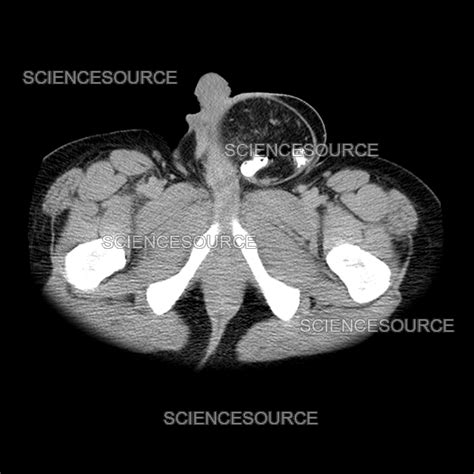 Ct Large Inguinal Hernia Stock Image Science Source Images