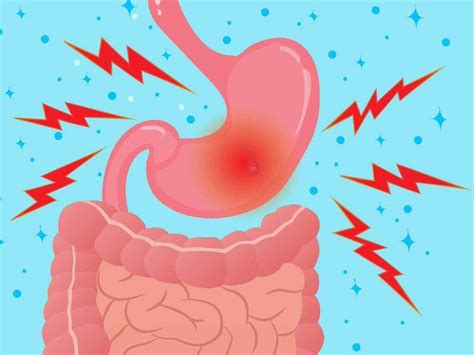 Bleeding Ulcer 10 Bleeding Ulcer Symptoms