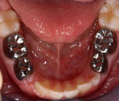Uso De Coronas Metálicas En Odontopediatría Odontobebe