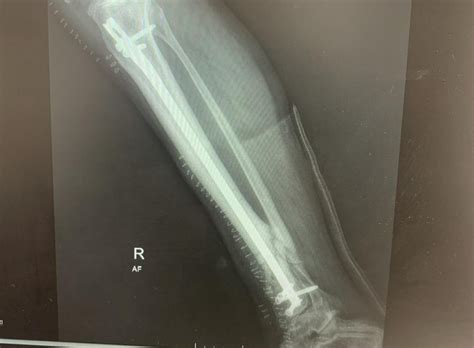 42 Y O Male With A Tibia Fibula Compound Fracture R Radiology