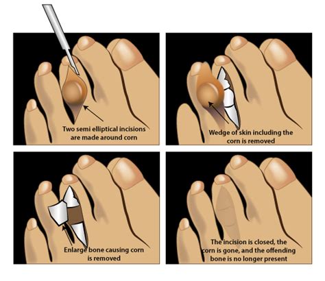 More Hammertoe Surgical Procedues