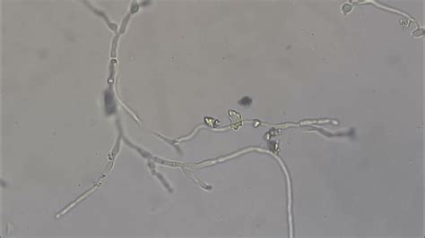 Fungal Pseudohyphae In Koh Mount Of Sputum At Magnification Of 400x