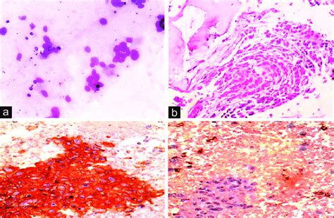 A Case Of Ewingsprimitive Neuroectodermal Tumor With Bone Marrow Download Scientific Diagram