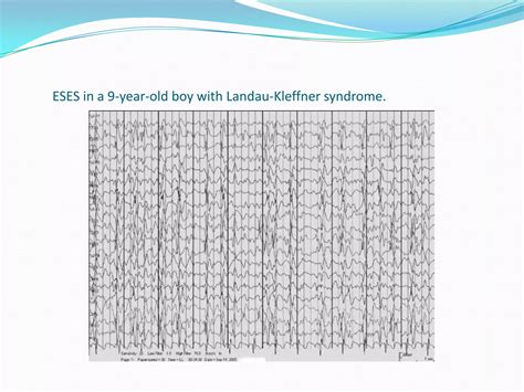 Epileptic Encephalopathy Eeg Ppt Epileptic Encephalopathy Eeg Ppt