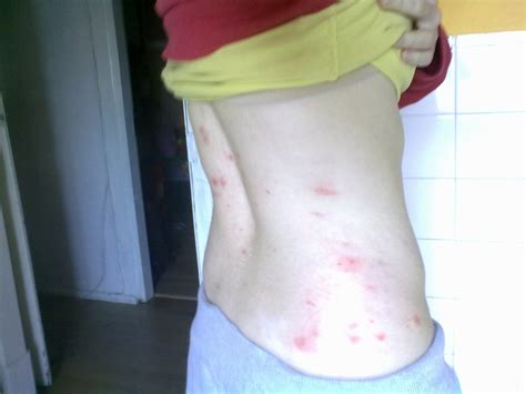 Flea Bites On Humans Symptoms And Treatment Dengarden