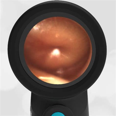 Acute Otitis Media Aom Wiscmed