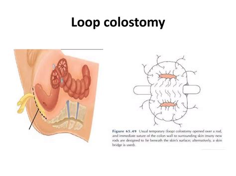 Colostomy Pptx