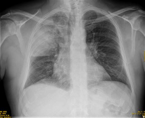 Etapas De La Neumonia Lobar