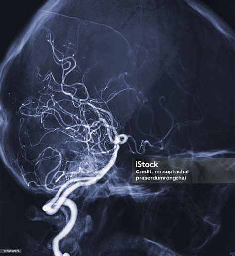 Cerebral Angiography Image From Fluoroscopy In Intervention Radiology