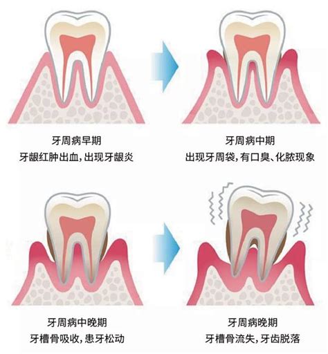 牙周病的搜索结果百度图片搜索