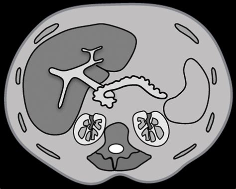 Liver Iron Quantification Mri Radiology At Deborah Mcgee Blog