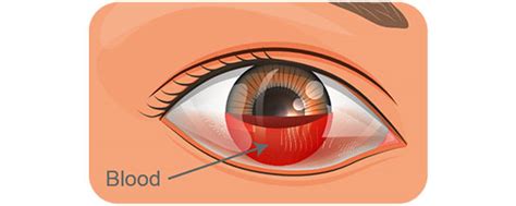 Hyphema Bleeding In The Eye Sidra Medicine