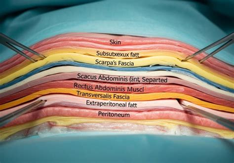 Cross Sectional Diagram Illustrating Layers Of The Abdominal Wall