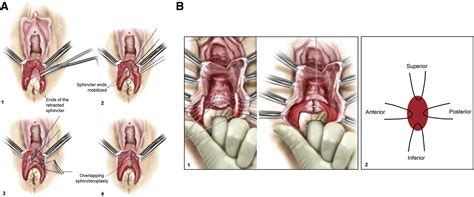 Repair Of Episiotomy And Obstetrical Perineal Lacerations Firstfourth
