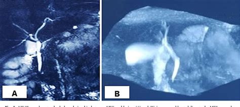 Complete Enucleation Of A Complicated Solid Pseudopapillary Neoplasm Of