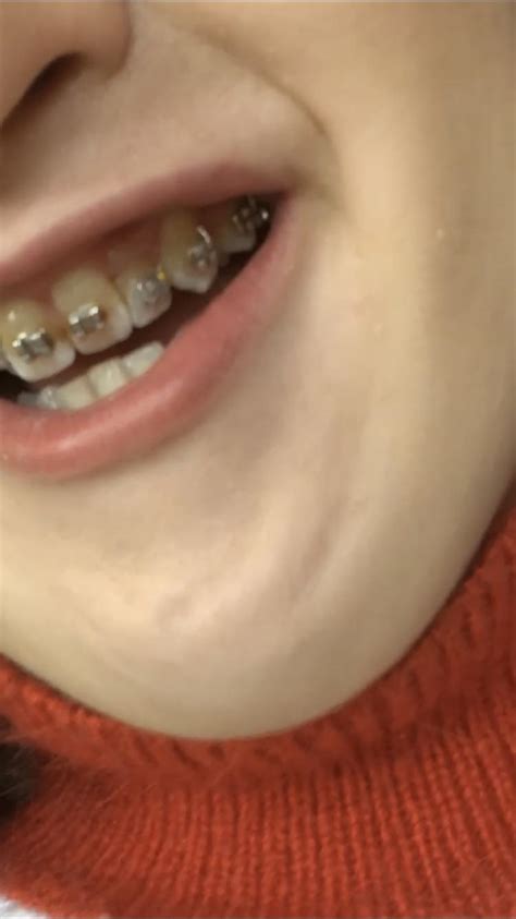 Behold The Weird Staining I Started To Notice A Few Months Into My