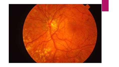 Fundoscopy Images 1pptx Eye And Vision Conditions Diseases And