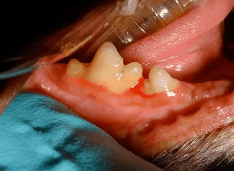 Granulation Tissue Tooth Extraction