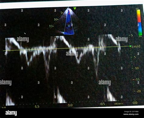 Echocardiography Or Cardiac Ultrasound Shows Normal Values Except For