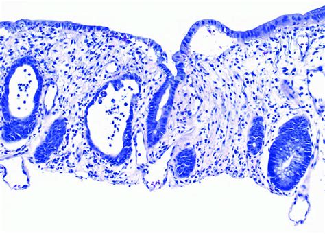 This Medium Power View Of Mycophenolate Colitis Shows Dilated And