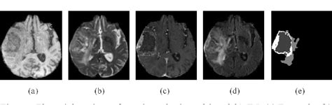 Figure From Multimodal Brain Tumor Image Segmentation Based On D CTrans U Net Replacing Skip