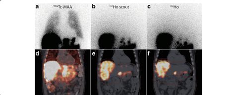 Example Of Lung Shunt Fraction Overestimation By 99m Tc Maa A Patient
