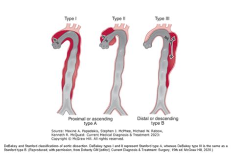 Ao Aneurysm And Dissection Flashcards Quizlet