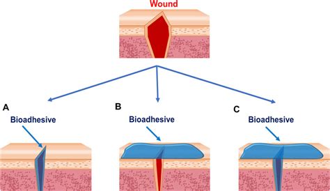 Frontiers Applications Of Bioadhesives A Mini Review